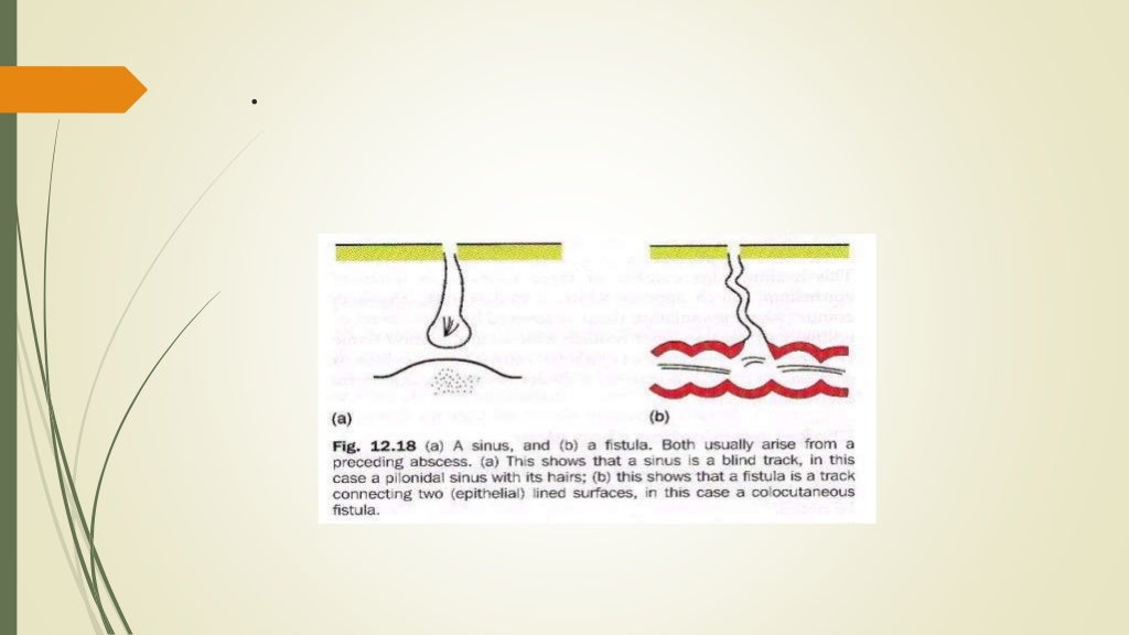 Sinus and fistula