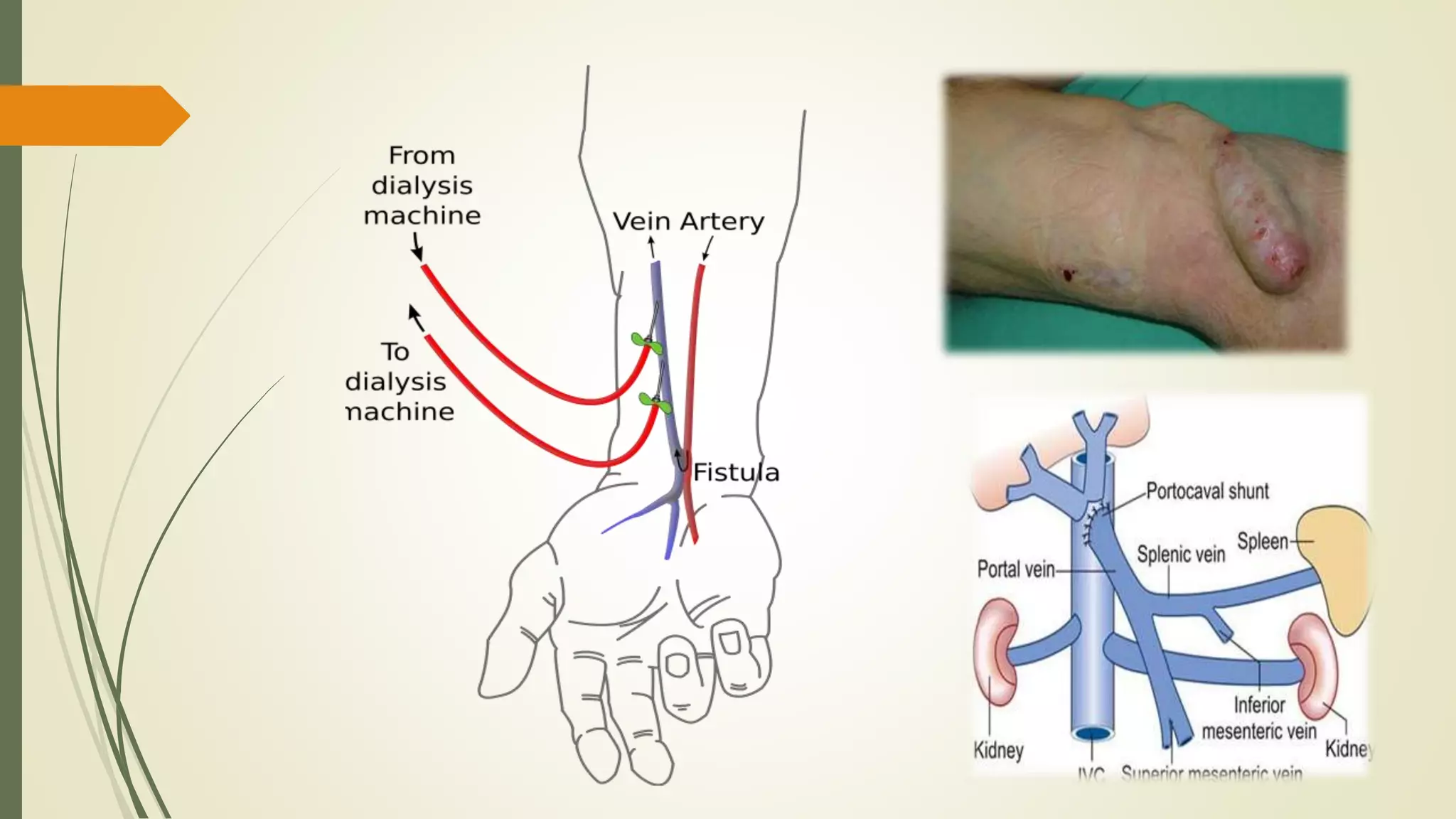 Sinus and fistula, TB lymphadenitis, anal fistula | PPTX
