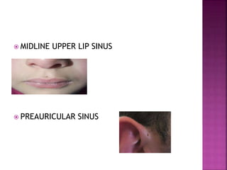 Sinus and fistula | PPTX