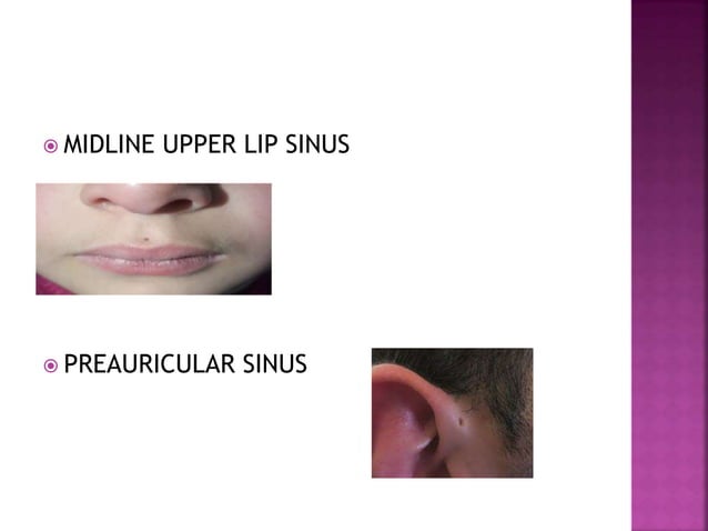 Sinus and fistula | PPTX | Ear, Nose and Throat Conditions | Diseases ...