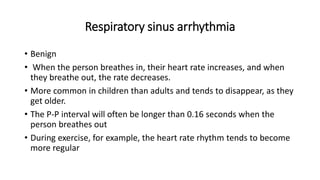 Sinus arrhythmia | PPTX