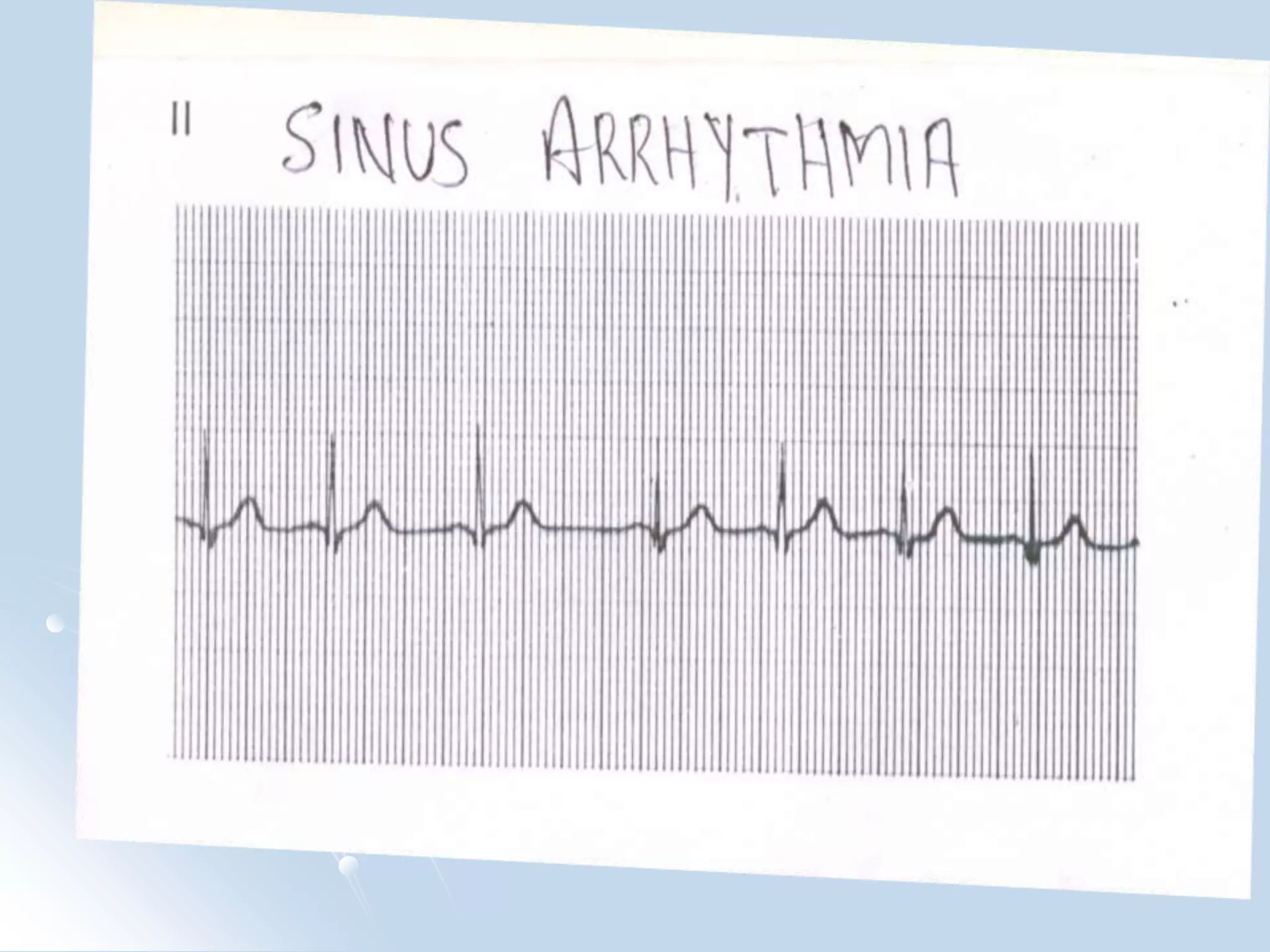 Sinus arrhythmia | PPT