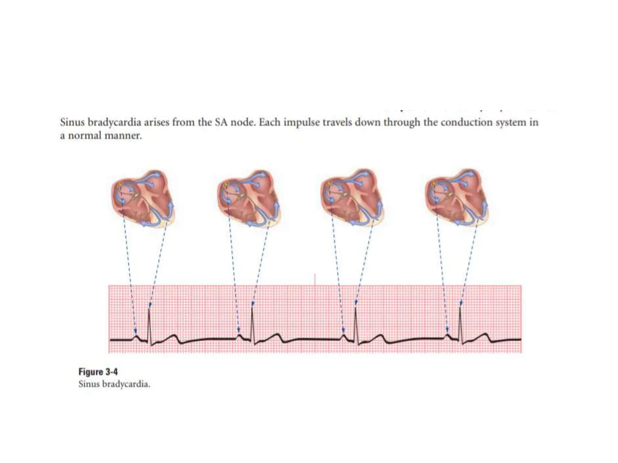 SINUS DYSRHYTHMIAS AND HOW TO DIAGNOSE IT? | PPTX