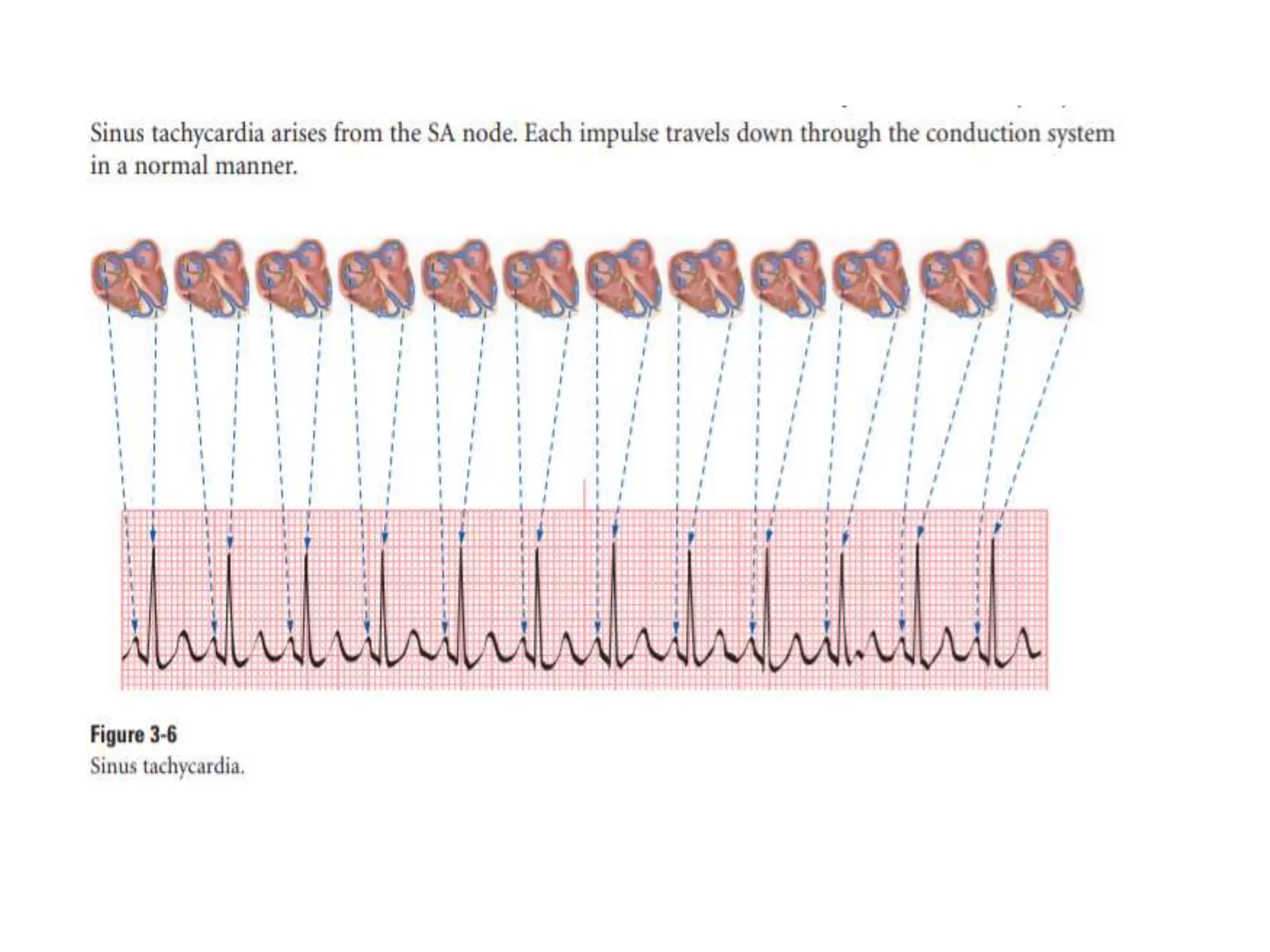 SINUS DYSRHYTHMIAS AND HOW TO DIAGNOSE IT? | PPTX