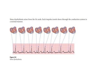 SINUS DYSRHYTHMIAS AND HOW TO DIAGNOSE IT? | PPTX