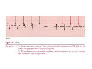 SINUS DYSRHYTHMIAS AND HOW TO DIAGNOSE IT? | PPTX