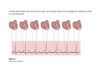 SINUS DYSRHYTHMIAS AND HOW TO DIAGNOSE IT? | PPTX