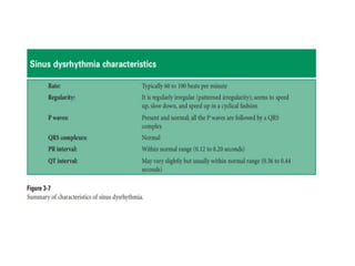 SINUS DYSRHYTHMIAS AND HOW TO DIAGNOSE IT? | PPTX