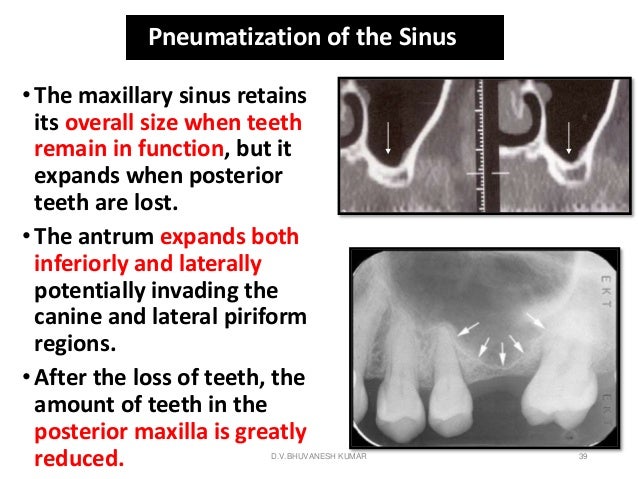 Sinus elevation ; grafts