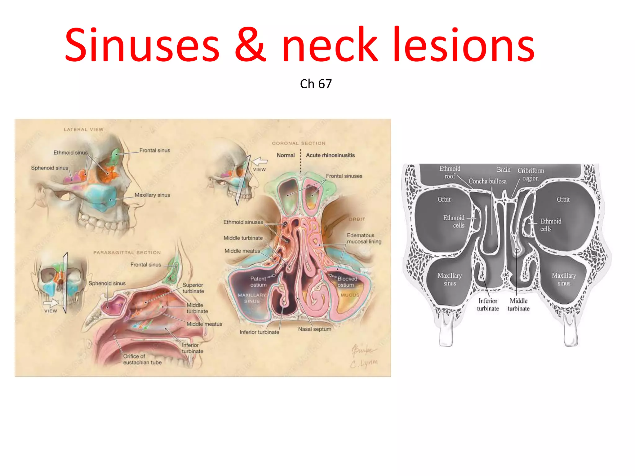 Sinuses & neck lesions | PPTX | Ear, Nose and Throat Conditions ...