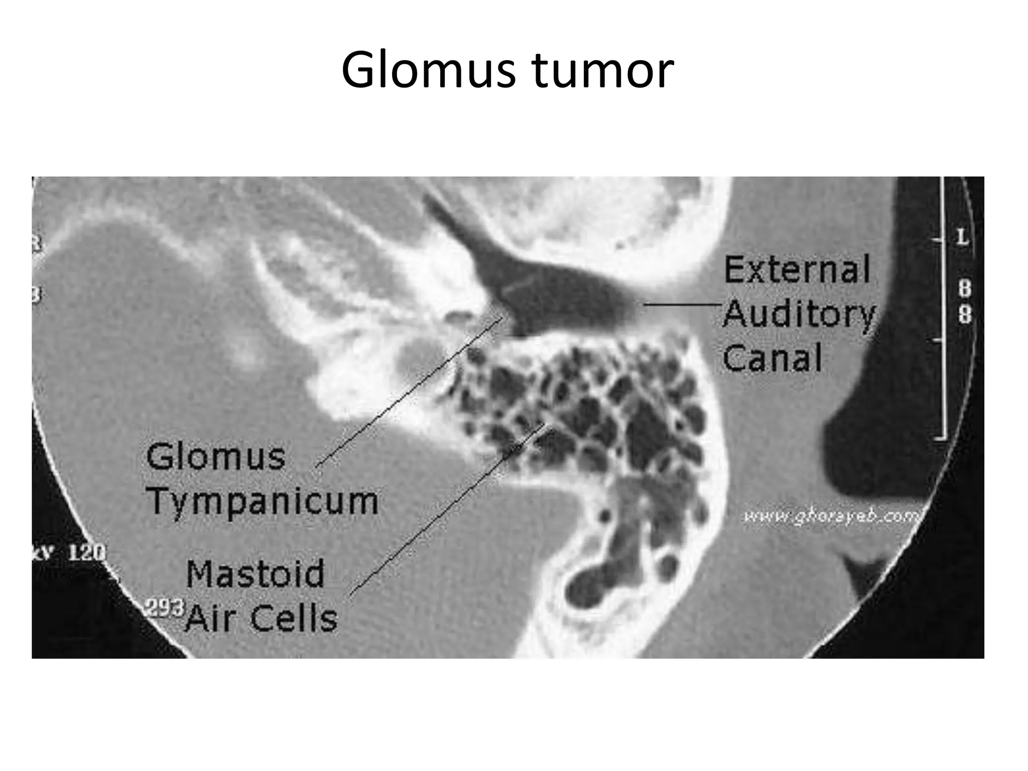 Sinuses & neck lesions | PPTX | Ear, Nose and Throat Conditions ...