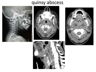 Sinuses & neck lesions | PPT