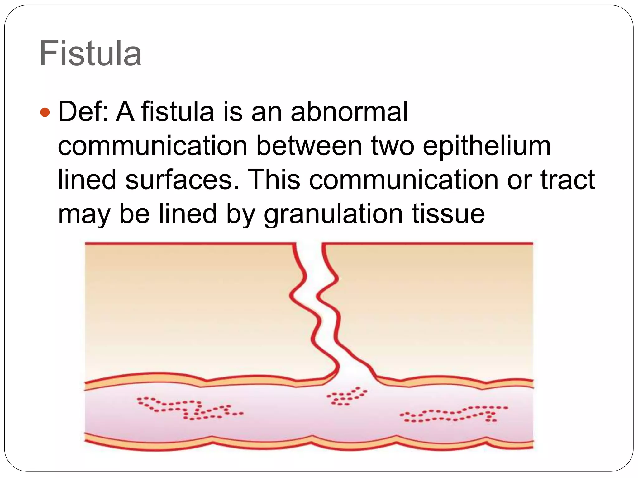 Sinus, fistula, cyst | PPTX