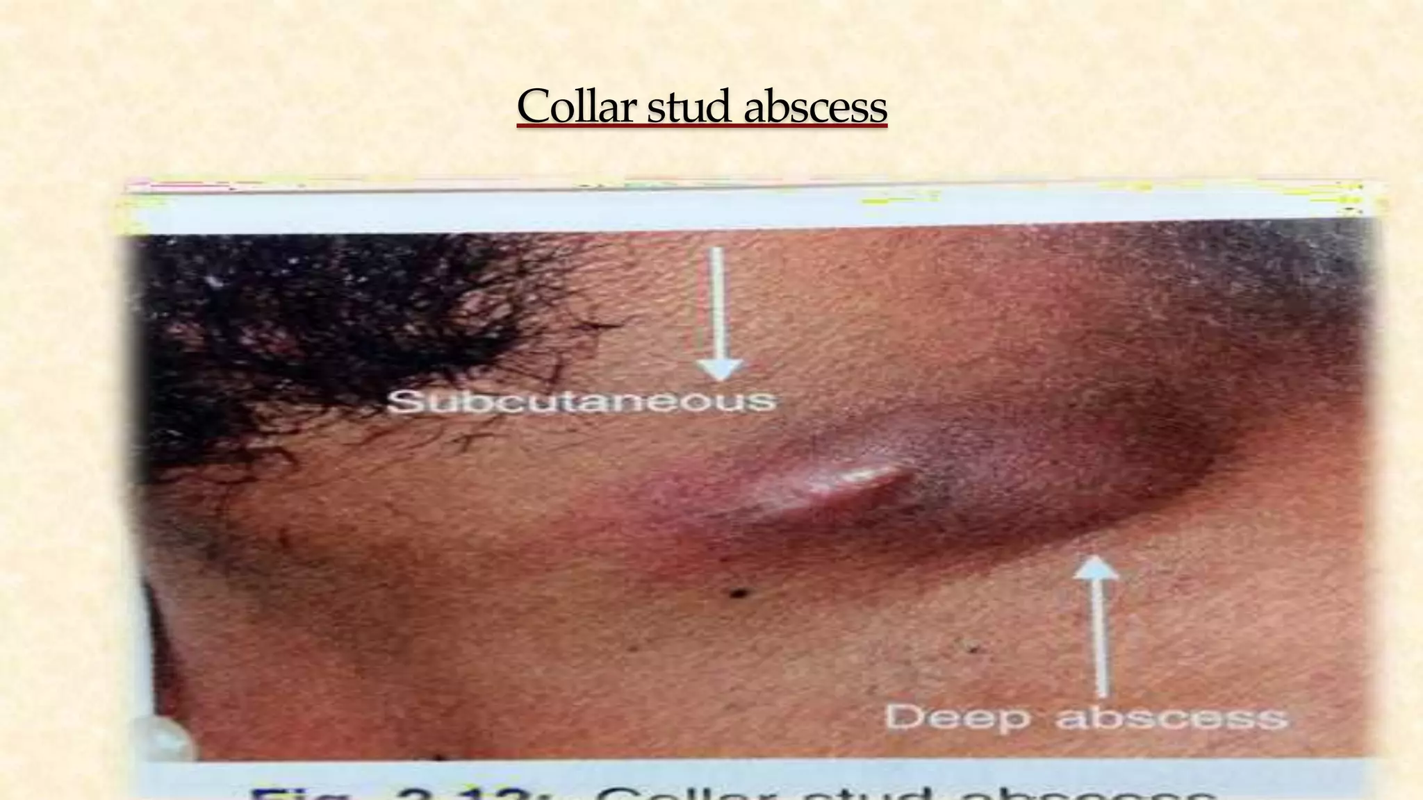 sinusfistula ppt 32.pptx