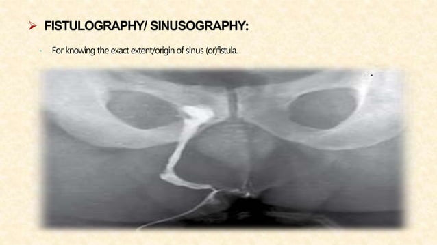 sinusfistula ppt 32.pptx