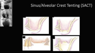 Sinus grafting condensed | PPTX