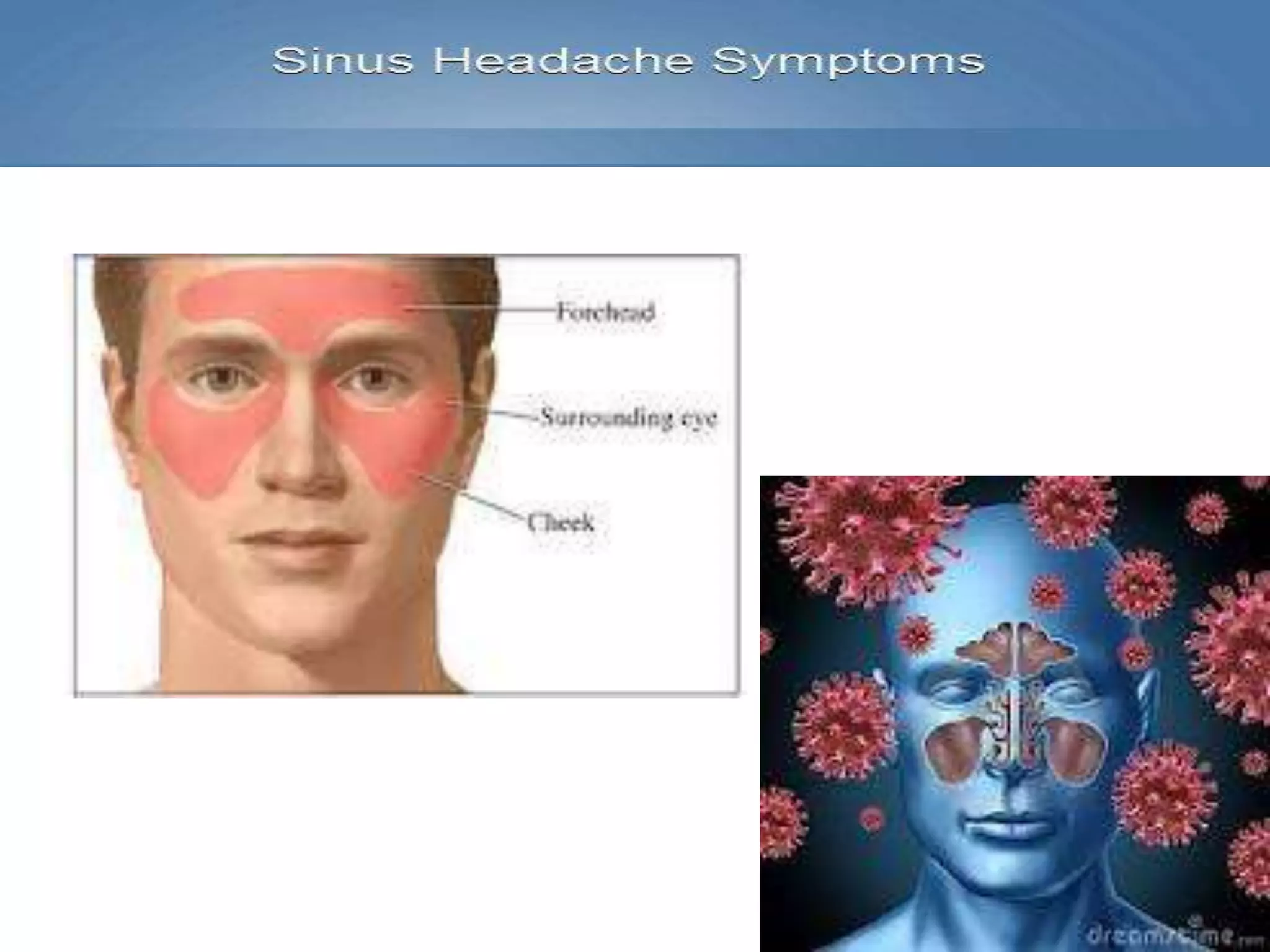 Sinus headache | PPTX