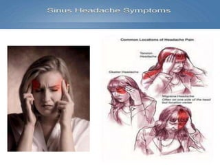 Sinus headache | PPTX