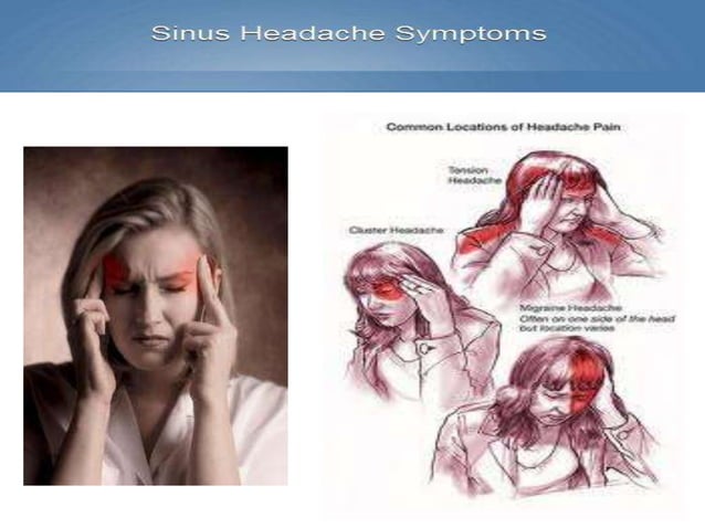 Sinus headache | PPTX