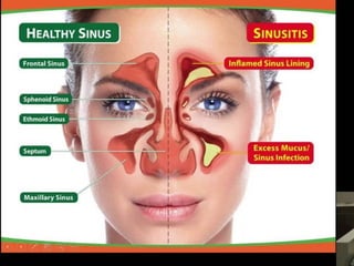 sinusitis INFECTION IN AFRICAN CON.pptx