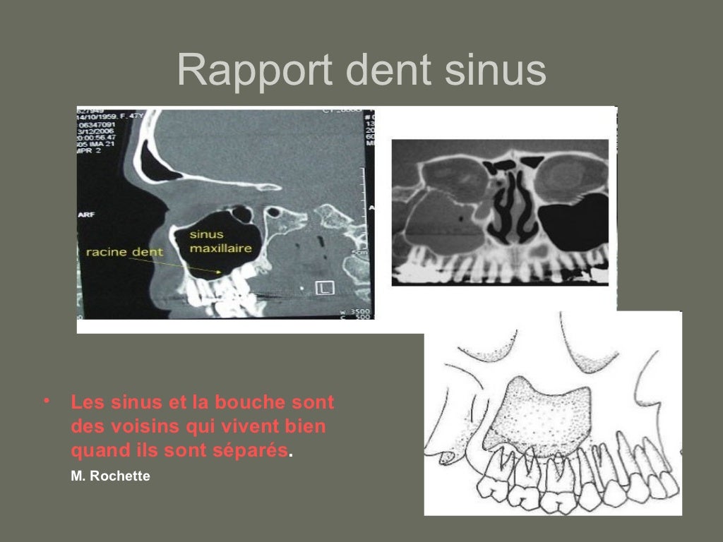 SINUSITE MAXILLAIRE D'ORIGINE DENTAIRE