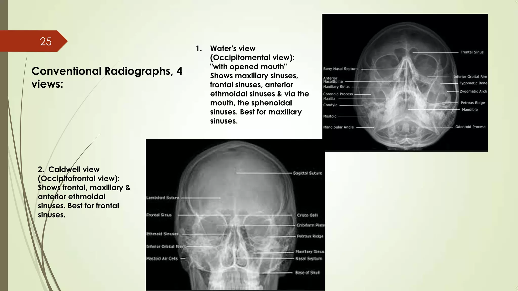 Sinusitis | PPTX