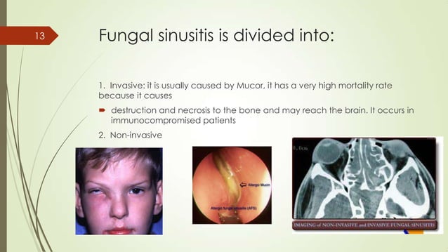 Sinusitis | PPTX | Ear, Nose and Throat Conditions | Diseases and ...