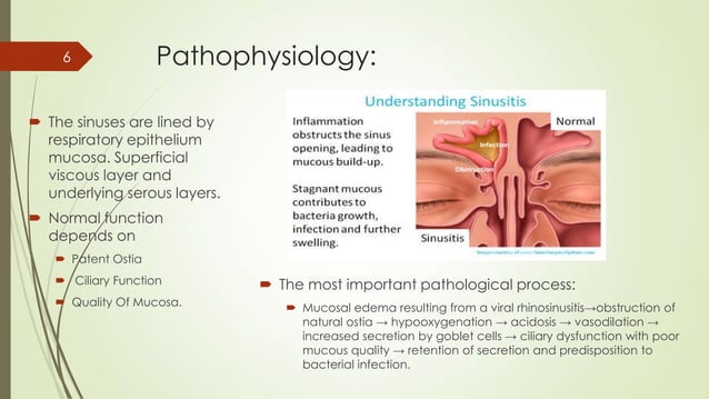 Sinusitis | PPTX | Ear, Nose and Throat Conditions | Diseases and ...