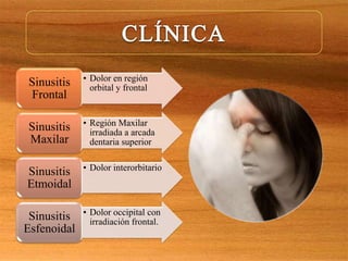 Sinusitis | PPTX