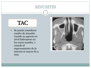 Sinusitis | PPTX