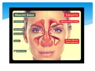 Sinusitis dan Penanganan Fisioterapi | PPTX