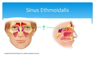 Sinusitis dan Penanganan Fisioterapi | PPTX