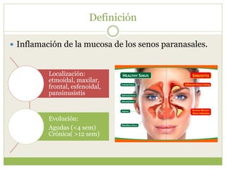Sinusitis | PPTX