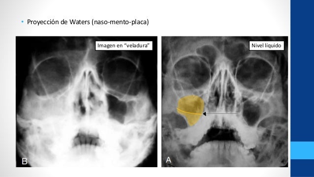Sinusitis aguda y crónica.
