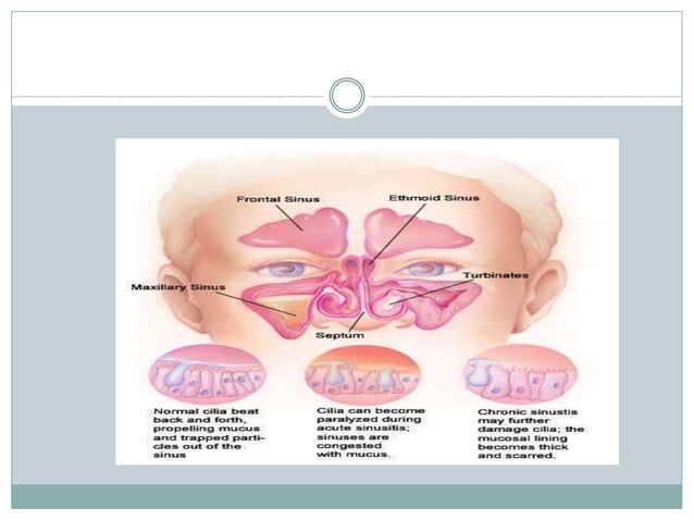 Sinusitis | PPT