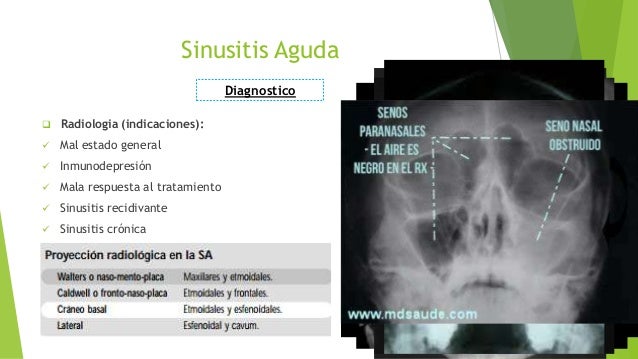 Sinusitis