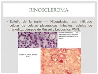 Sinusitis | PPTX