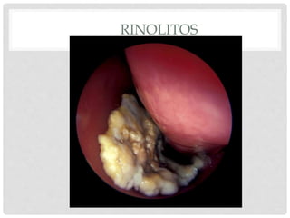 Sinusitis | PPTX