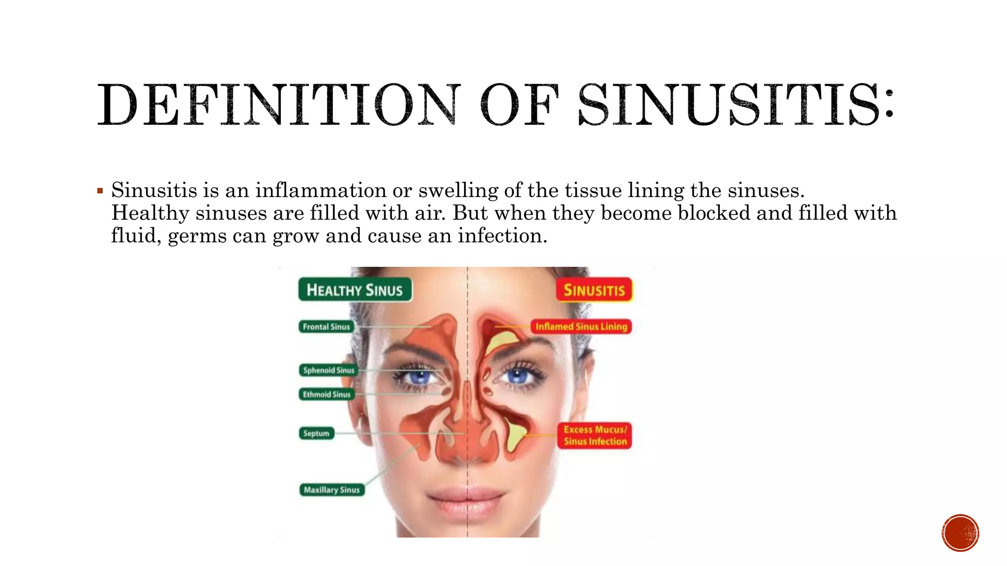 Sinusitis | PPTX