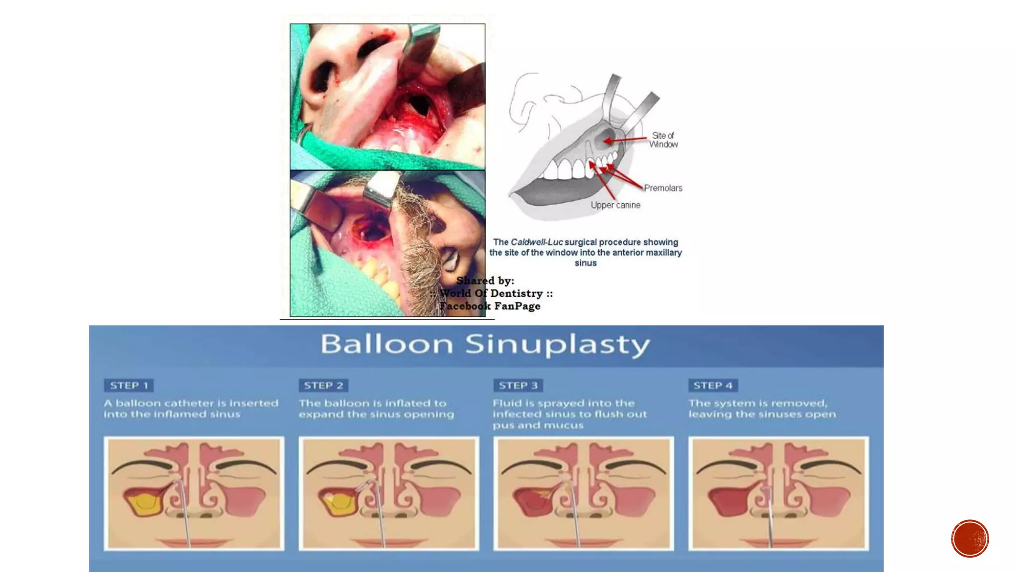 Sinusitis | PPTX