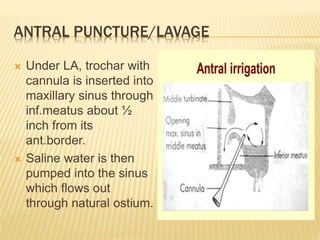 Sinusitis / Dr.Varsha Dhage | PPT