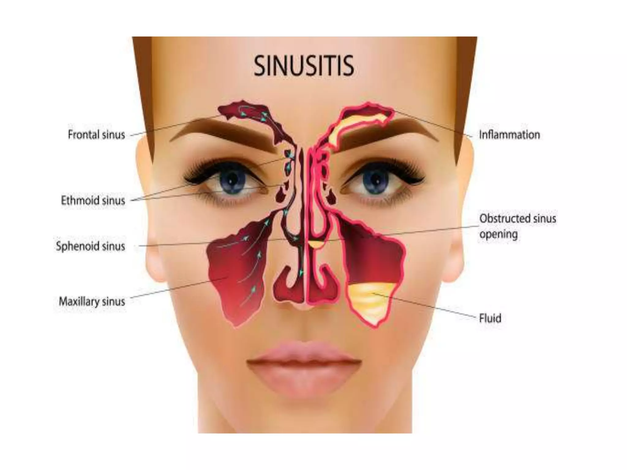 BACTERIAL SINUSITIS - CASE DISCUSSION | PPTX