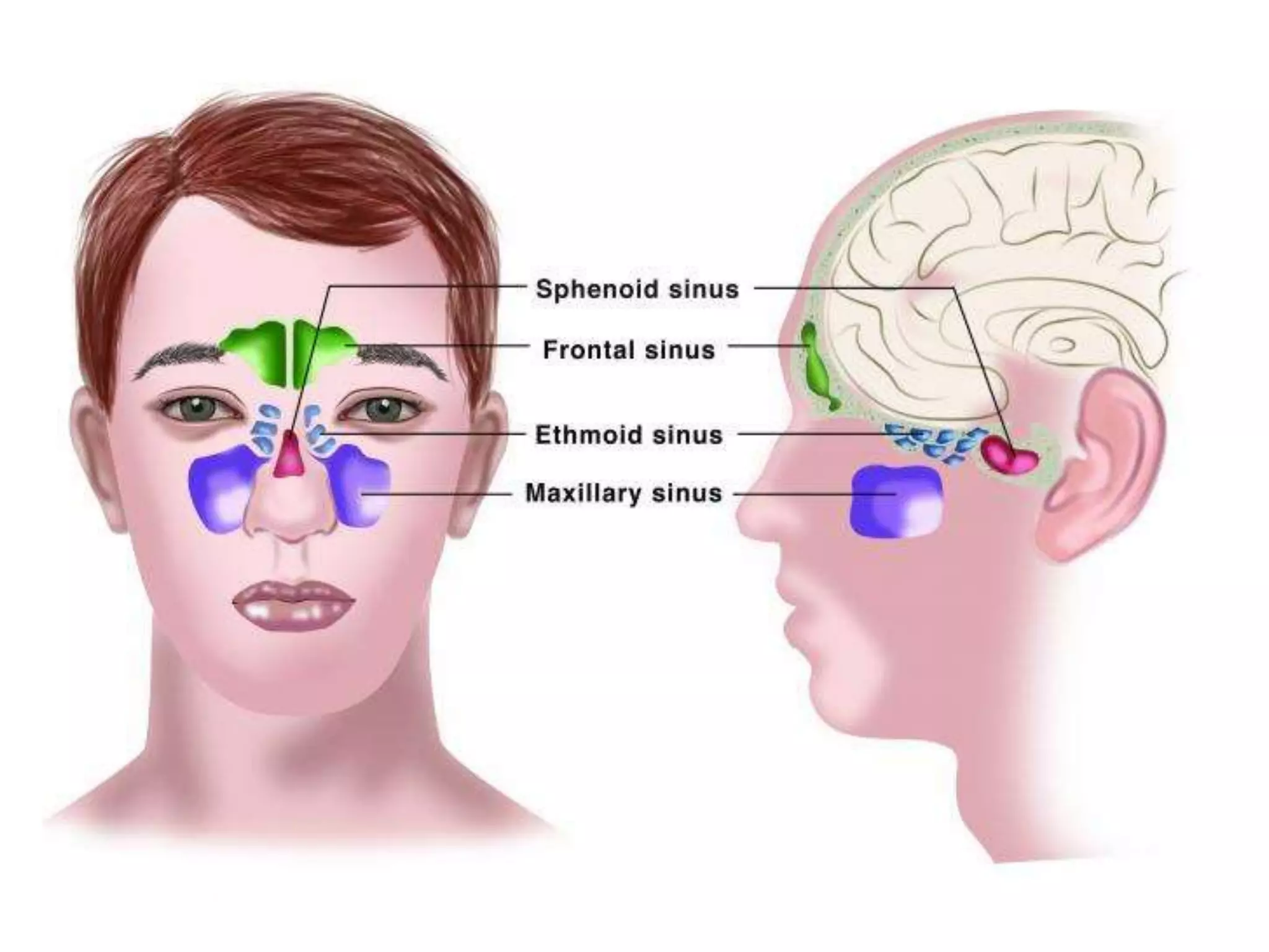 BACTERIAL SINUSITIS - CASE DISCUSSION | PPTX