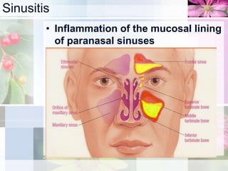 sinusitis.ppt