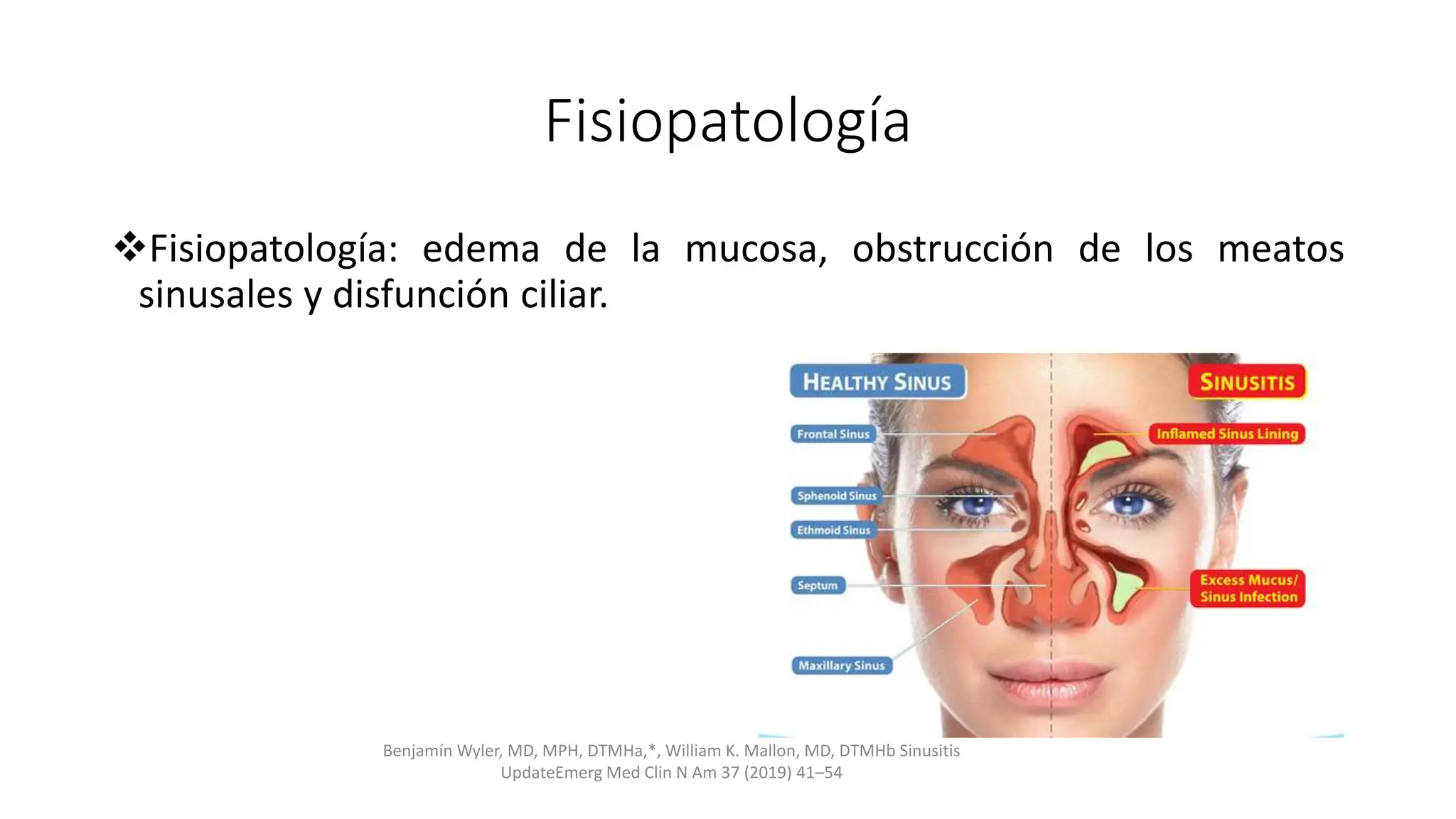 Clase de sinusitis de la materia de medicina interna | PPTX