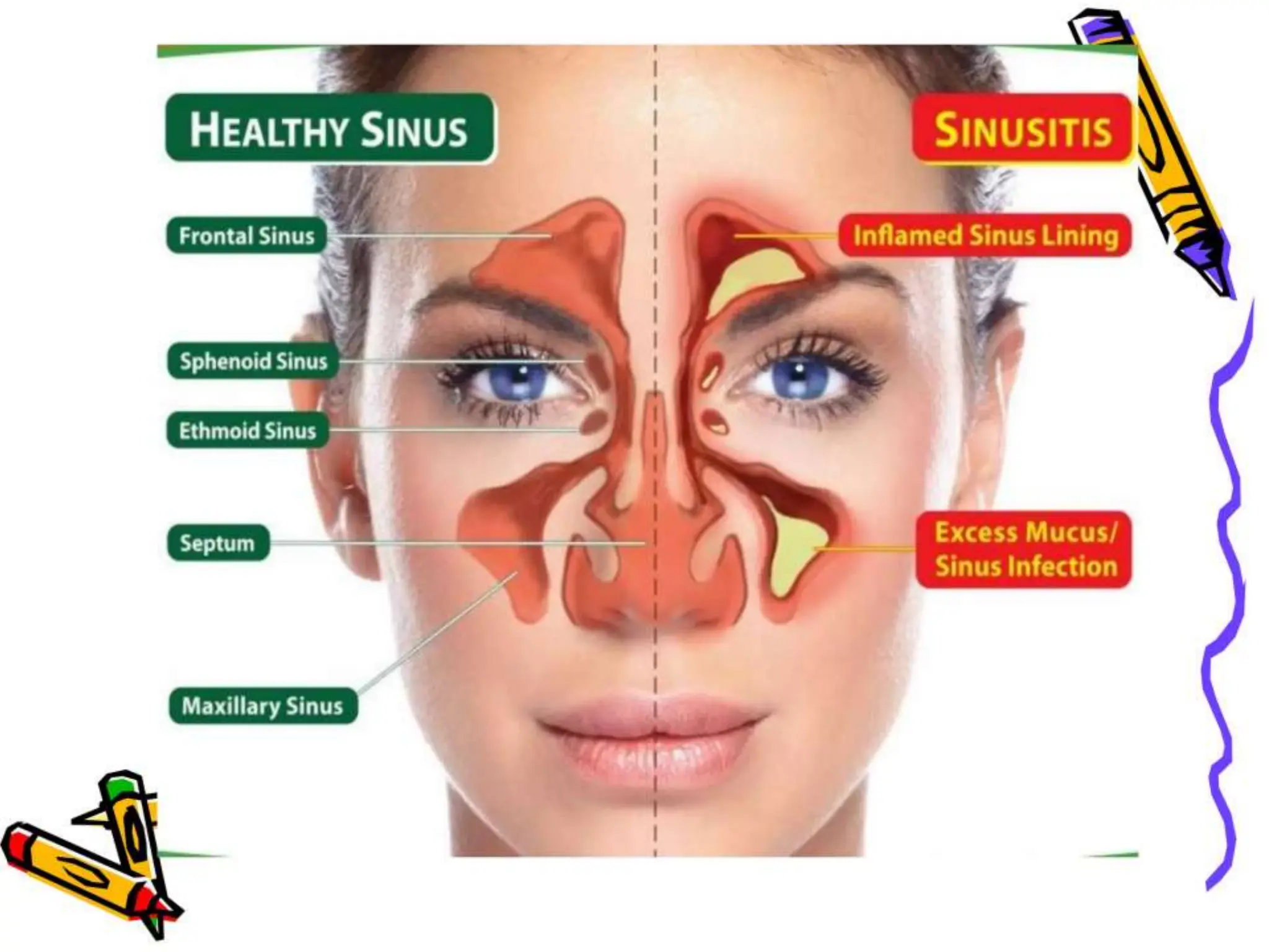 SINUSITIS for BSc Nursing 3 Year Students | PPTX