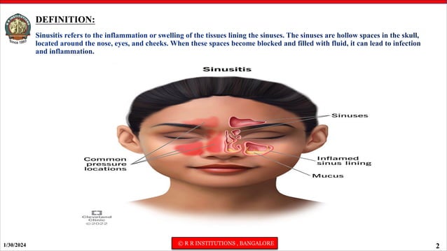 SINUSITIS AND ITS NURSING MANAGEMENT.pdf