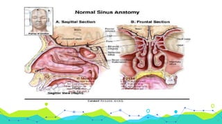 sinusitisSinusitis - Gejala, Penyebab, dan Pengobatan - Alodokter | PPTX