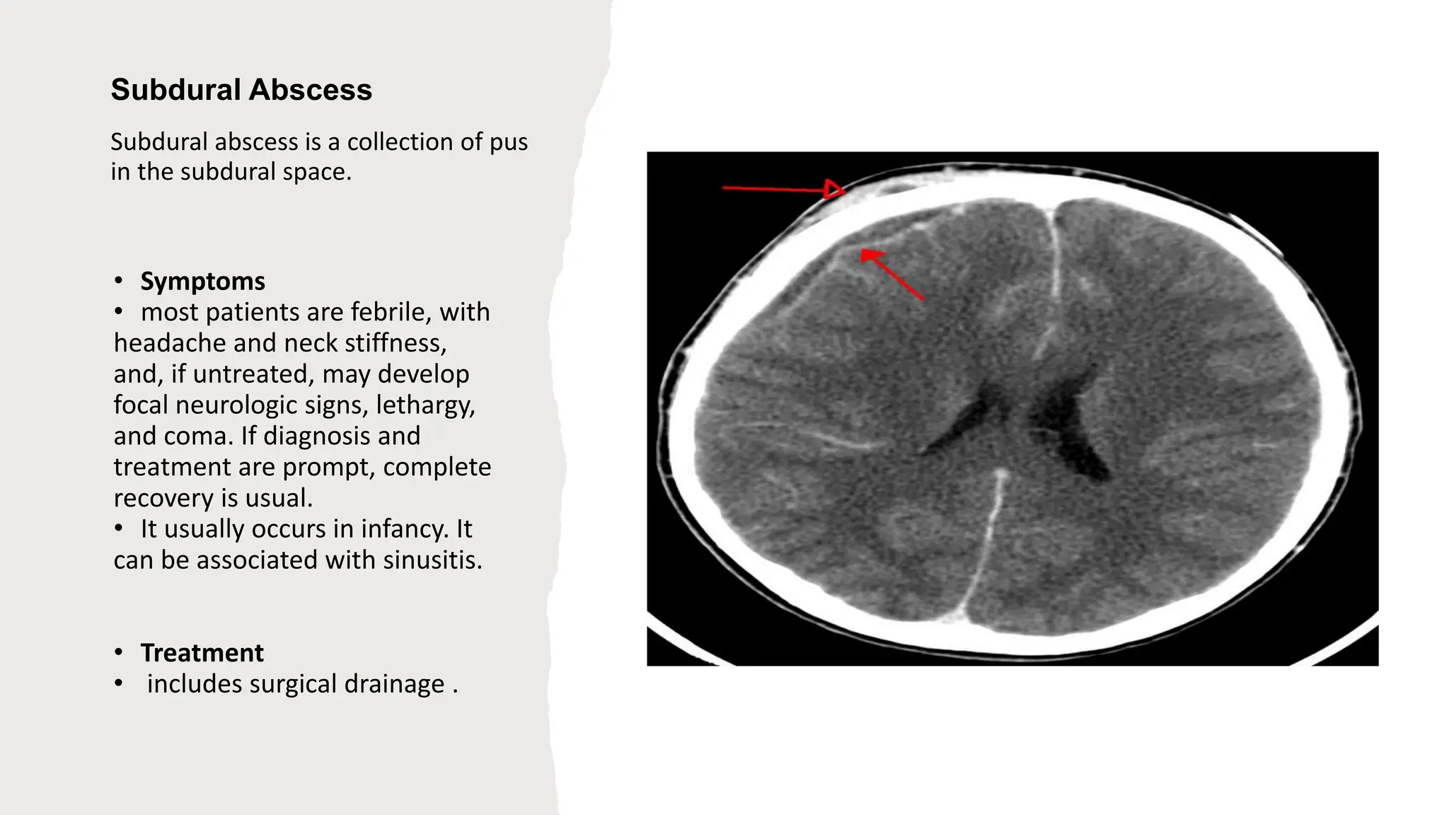 different complications of sinusitis.pptx