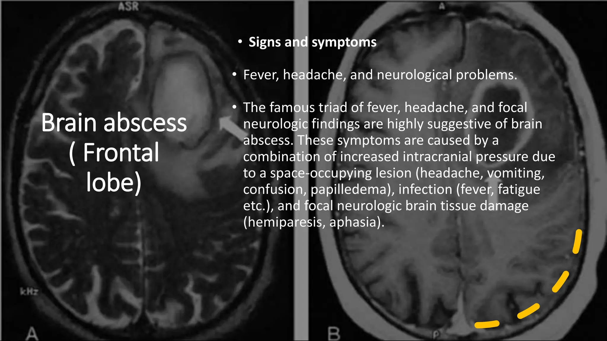 different complications of sinusitis.pptx